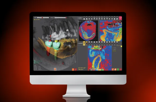 How one day implant is possible