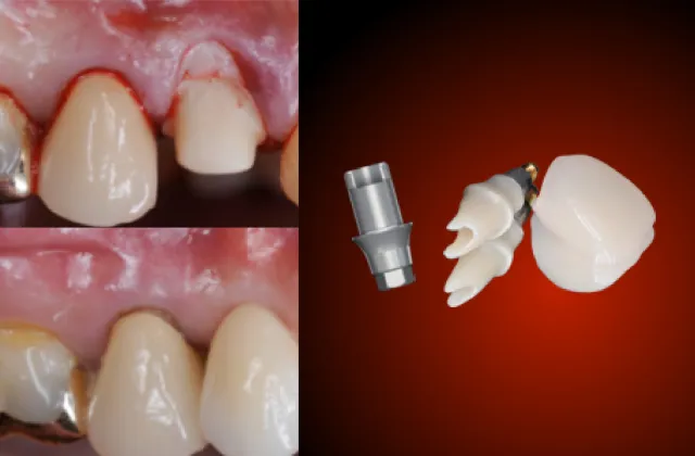 Cemented implant type