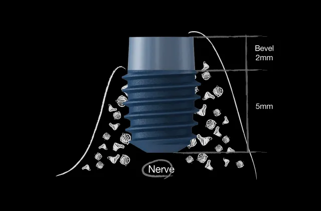 anyone special 7mm implants