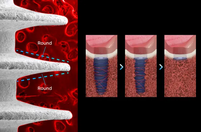 anyridge incisor implant sufficient space for angiogenesis