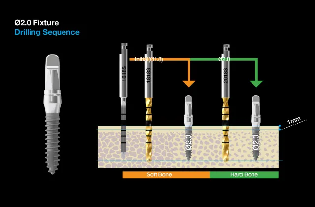 mini implant drilling sequence example 1