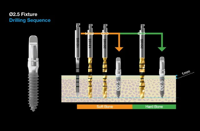 mini implant drilling sequence example 2