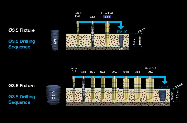 anyone surgical kit drilling sequence example