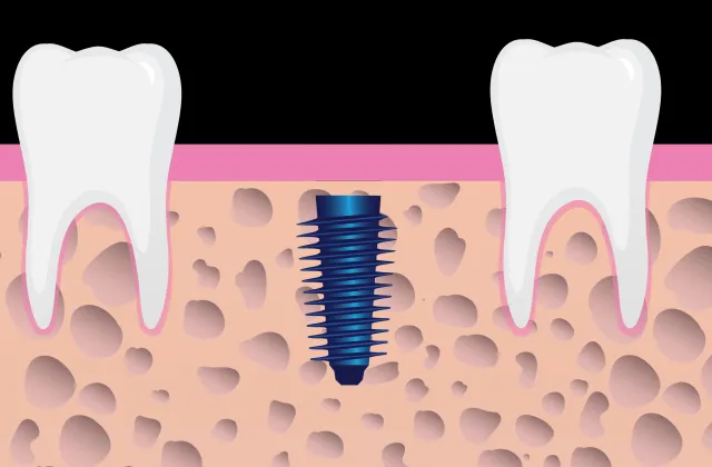 Anyridge implants in soft bone.