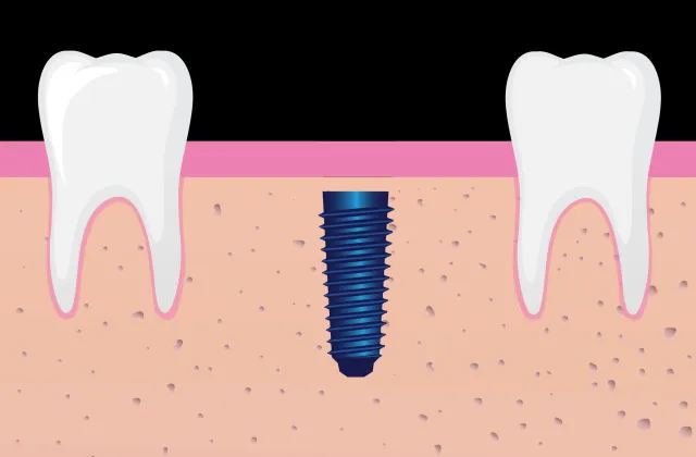 Anyridge implants in hard bone.