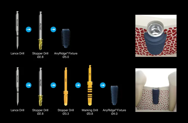 anyridge surgical kit drilling sequence 1