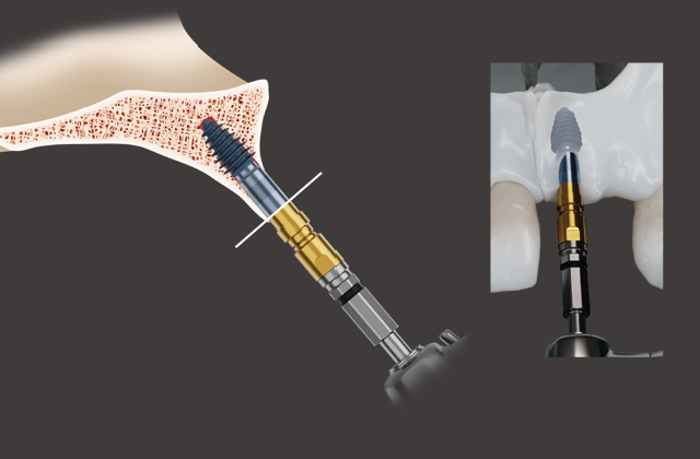 measuring height with caliper