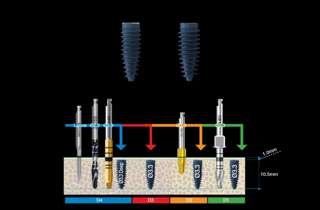 bluediamond implant drilling sequence example