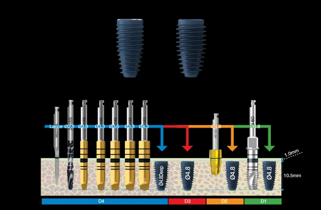 bluediamond implant drilling sequence example 2