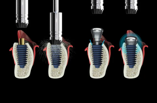 bone profiler kit step 1 to place guide pin