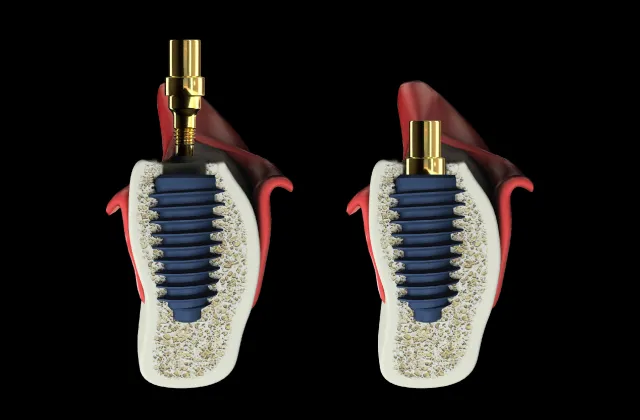 bone profiler kit step 2 to shave the overhanging bone.