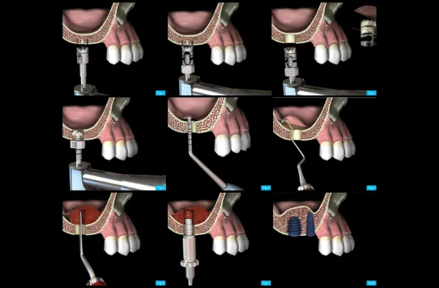 clear visualization of surgical site during Crestal Approach Sinus Lift