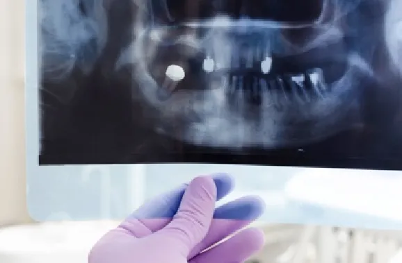 first step of the implant treatment is to get visualizations of the ...