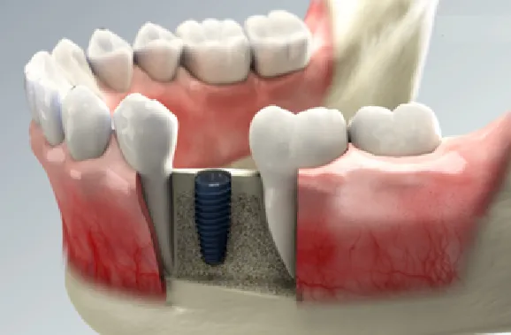 placing the implant 2
