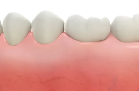 final crown restoration 2