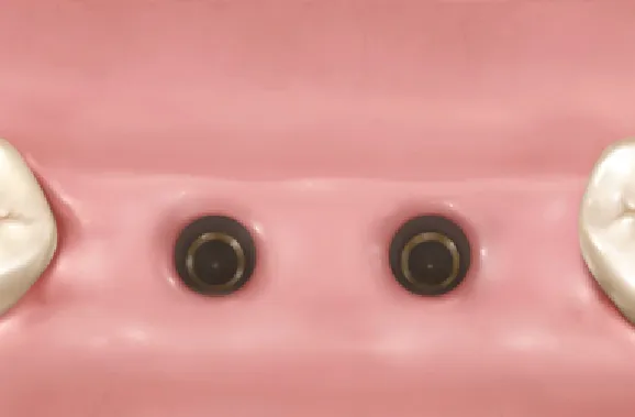 fabrication of guide stent 1