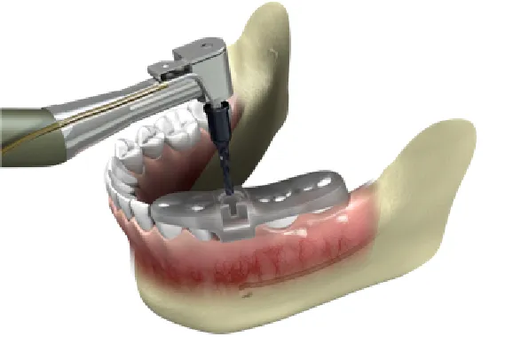 fabrication of guide stent 2