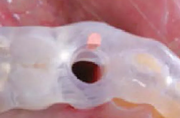 fabrication of guide stent 3