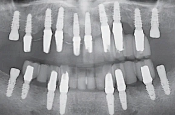 placing the implant using the stent + guided kit 2