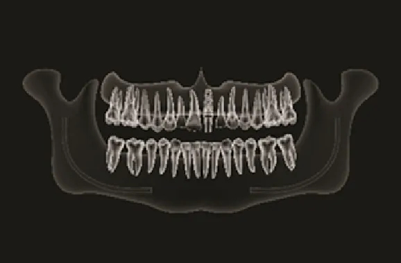 missing single top front tooth (maxillary incisor) 2