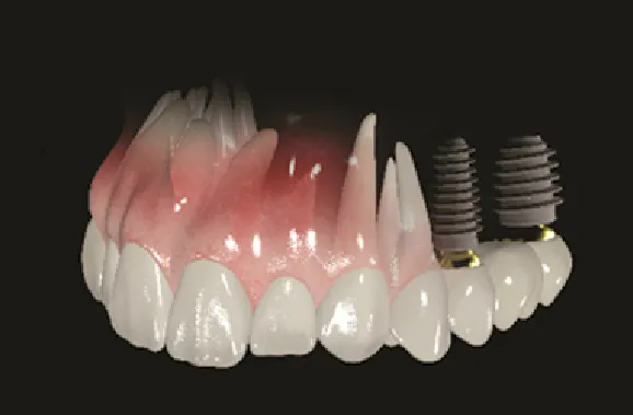 Missing multiple top back teeth (maxillary premolar or molar) 3