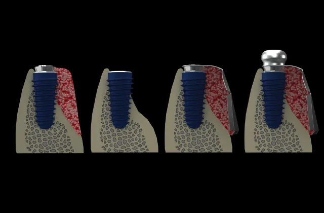 igen membrane applicability