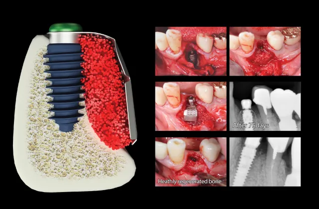 igen membrane compatibility with anyridge
