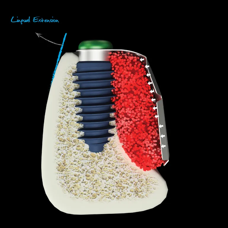 Lingual Extension for large defect
